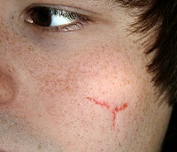 How Does Your Body Fix a Cut? | ASU - Ask A Biologist